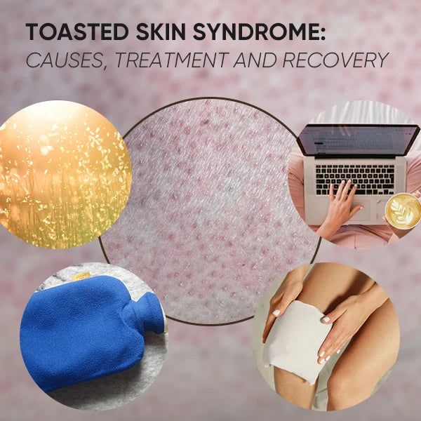 Toasted Skin Syndrome: Causes, Treatment and Recovery – Homlyns
